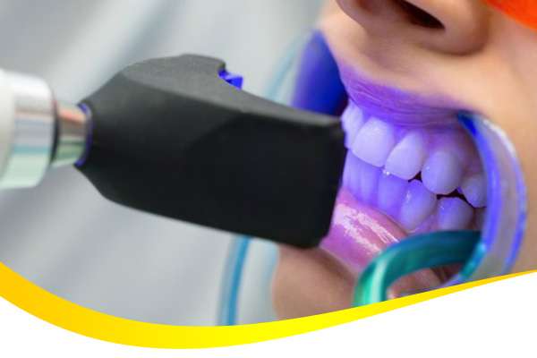 Bleaching - Teman Dental | Klinik Gigi Terpercaya Banyak Promo